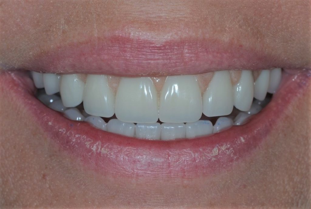 Easy & Simple Bone Regeneration Surgery | DDI (Dorset)