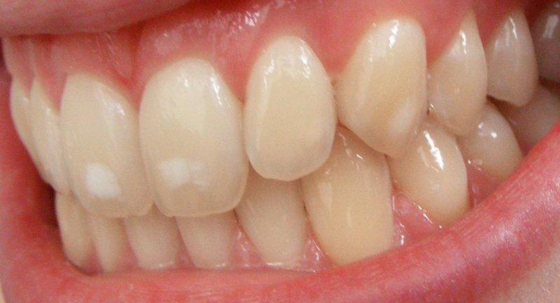 Causes of teeth loss. | DDI (Dorset)