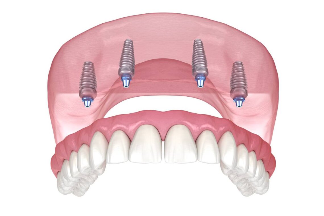 Palateless Dentures to Replace Regular Dentures | DDI (Dorset)